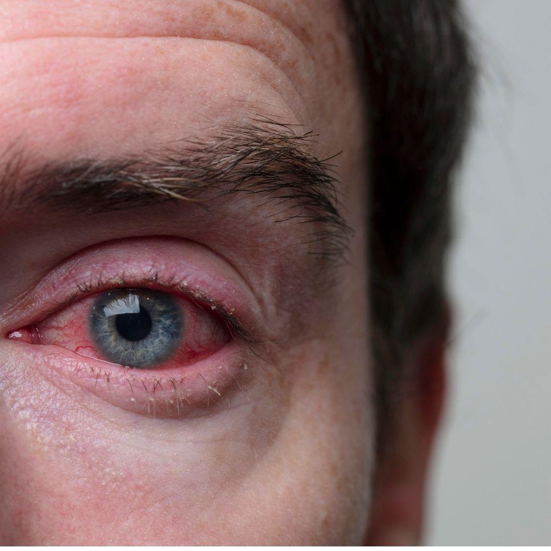Conjunctivitis: Understanding the "Pink Eye" Infection- Ashob-e-Chashm ...